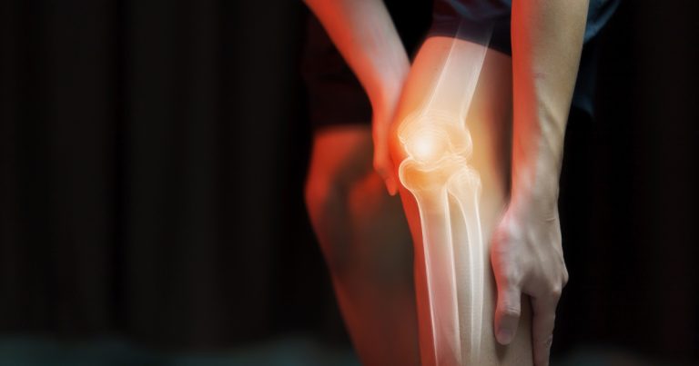 Entendendo a Artrose: Causas, Sintomas e Tratamentos