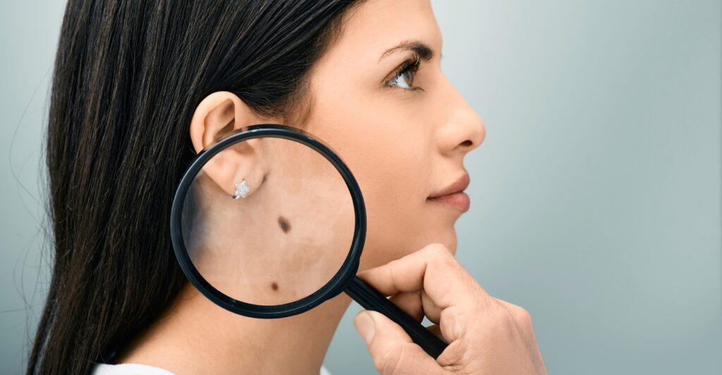 Pintas são naturais, mas o que significa quando crescem pelos nas pintas?